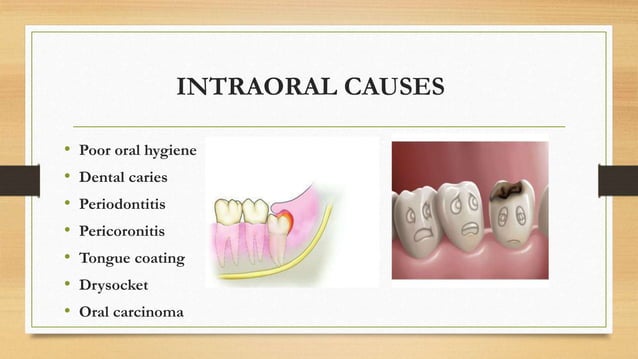 HALITOSIS_ diagnosis and management of halitosis | PPTX | Ear, Nose and ...