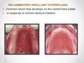 hard and soft palate | PPTX