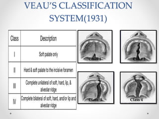hard and soft palate in prosthodontics | PPTX
