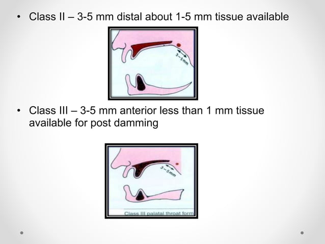 hard and soft palate in prosthodontics | PPTX