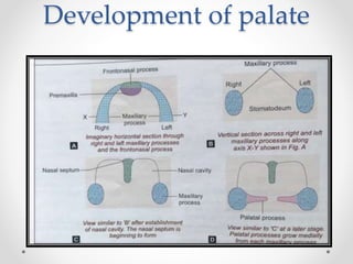 hard and soft palate in prosthodontics | PPTX