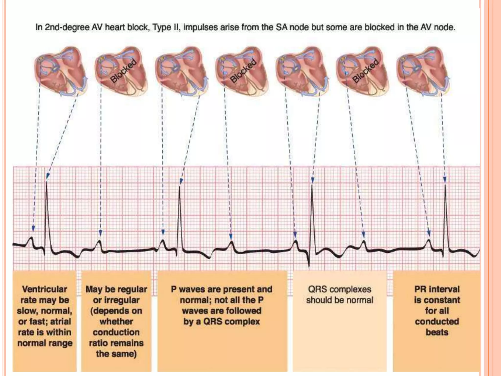 Heart block | PPTX | Heart and Cardiovascular Diseases | Diseases and ...