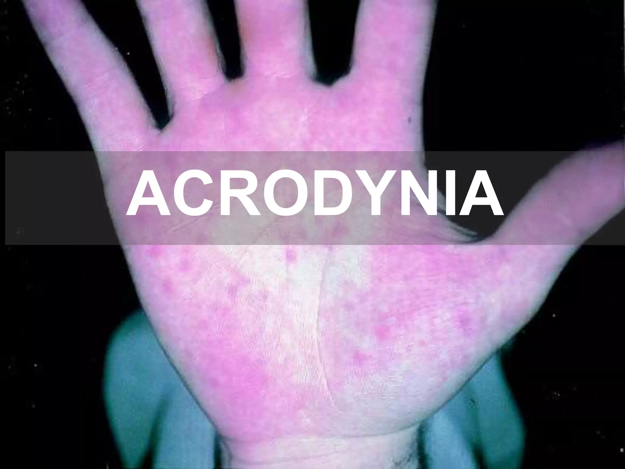 Heavy metal poisoning | PPTX