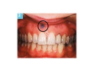 Heavy metal poisoning | PPTX