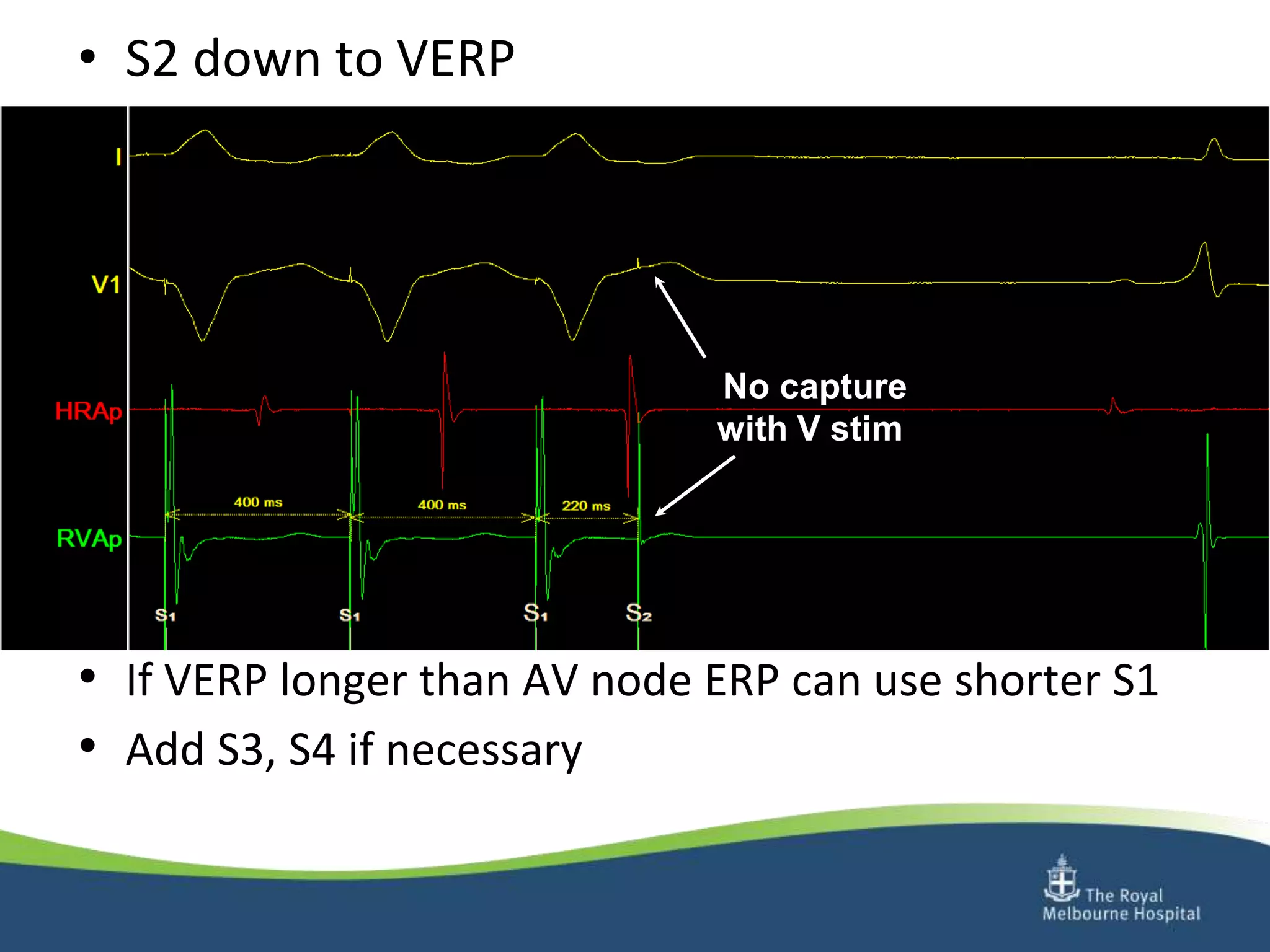 How to perform an ep study and diagnostic pacing during sinus rhythm | PPTX