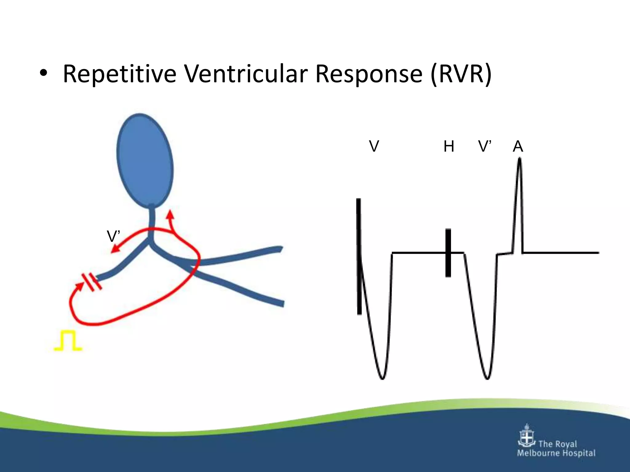 How to perform an ep study and diagnostic pacing during sinus rhythm | PPTX
