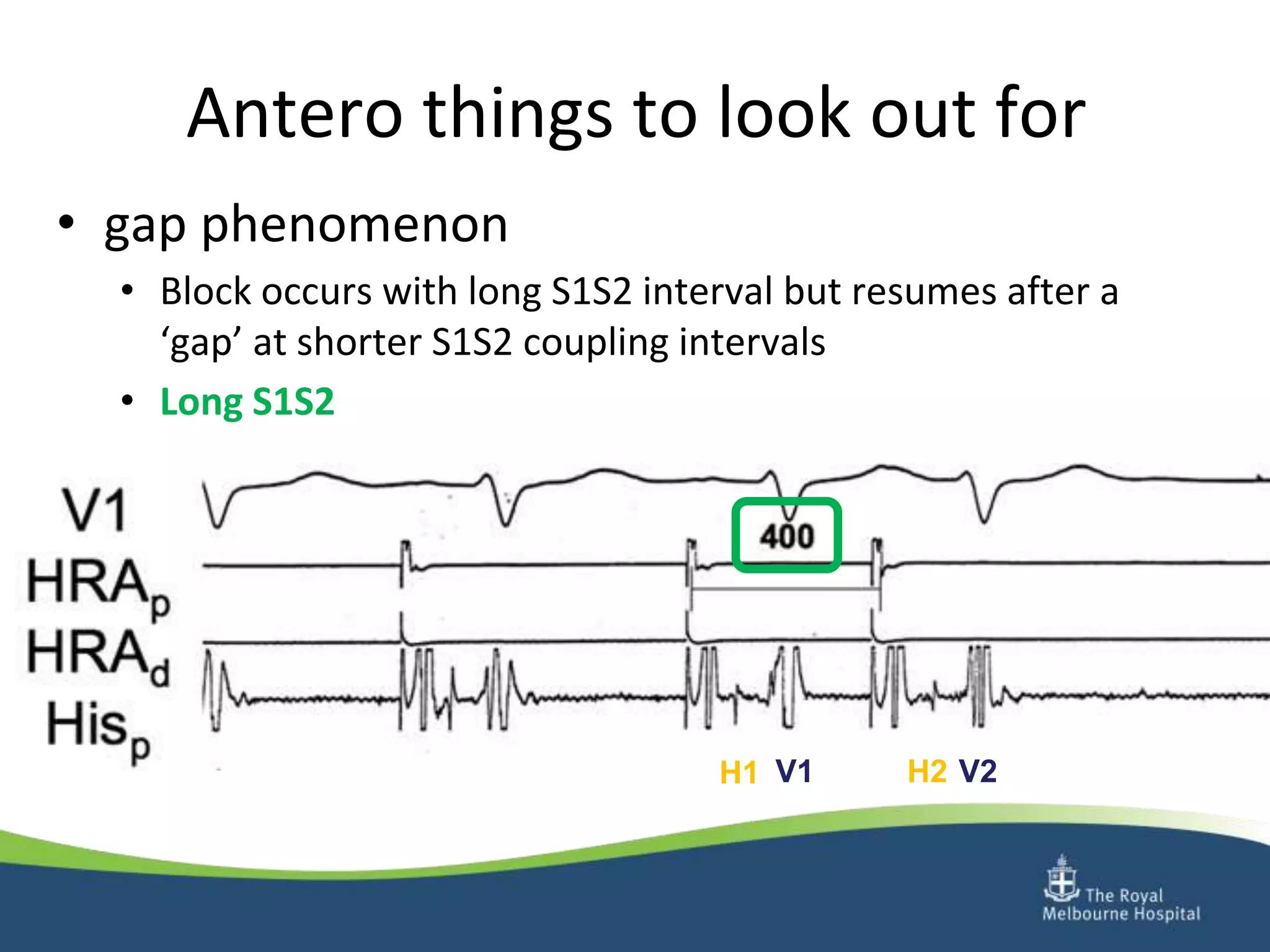 How to perform an ep study and diagnostic pacing during sinus rhythm | PPTX