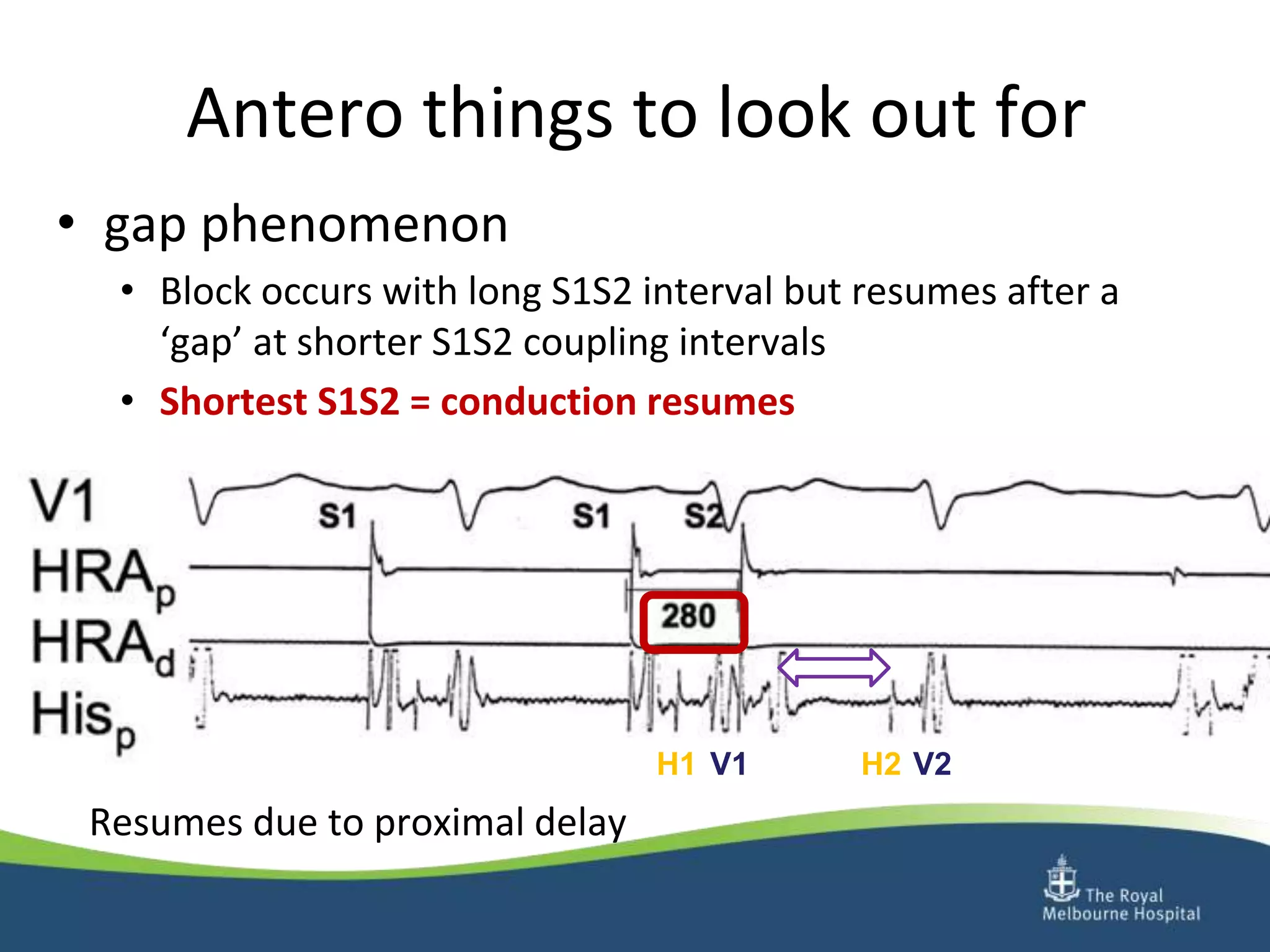 How to perform an ep study and diagnostic pacing during sinus rhythm | PPTX