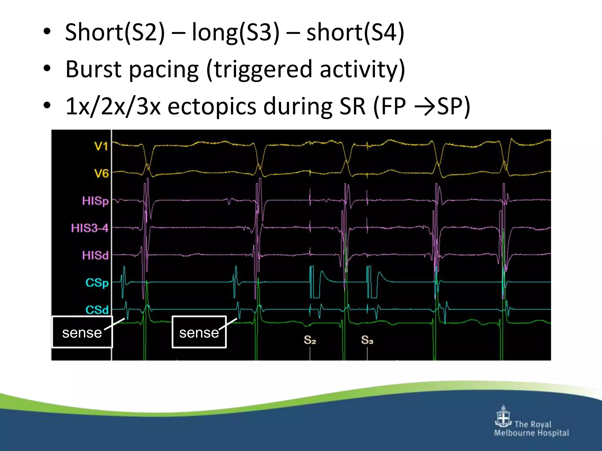 How to perform an ep study and diagnostic pacing during sinus rhythm | PPTX