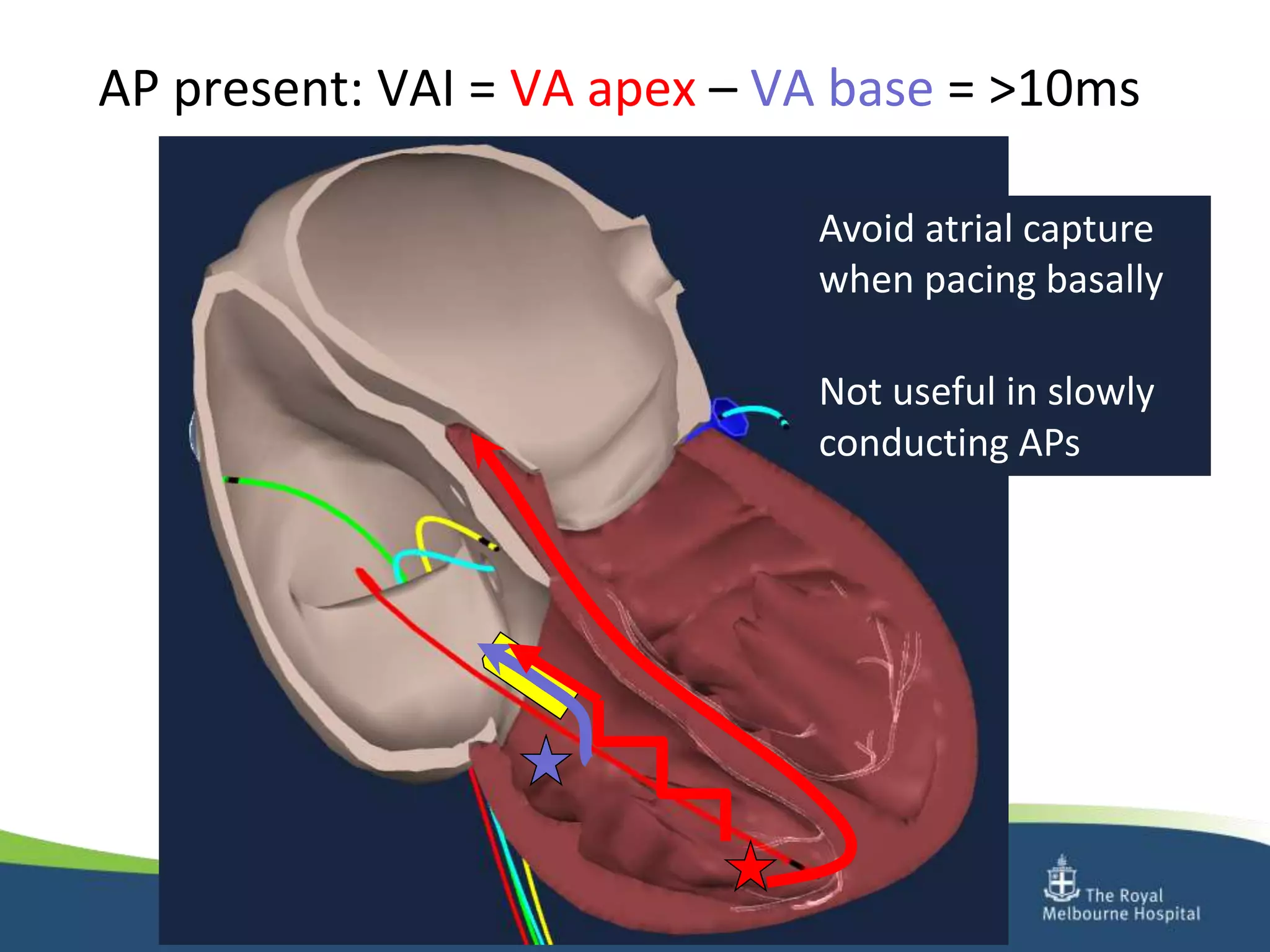How to perform an ep study and diagnostic pacing during sinus rhythm | PPTX