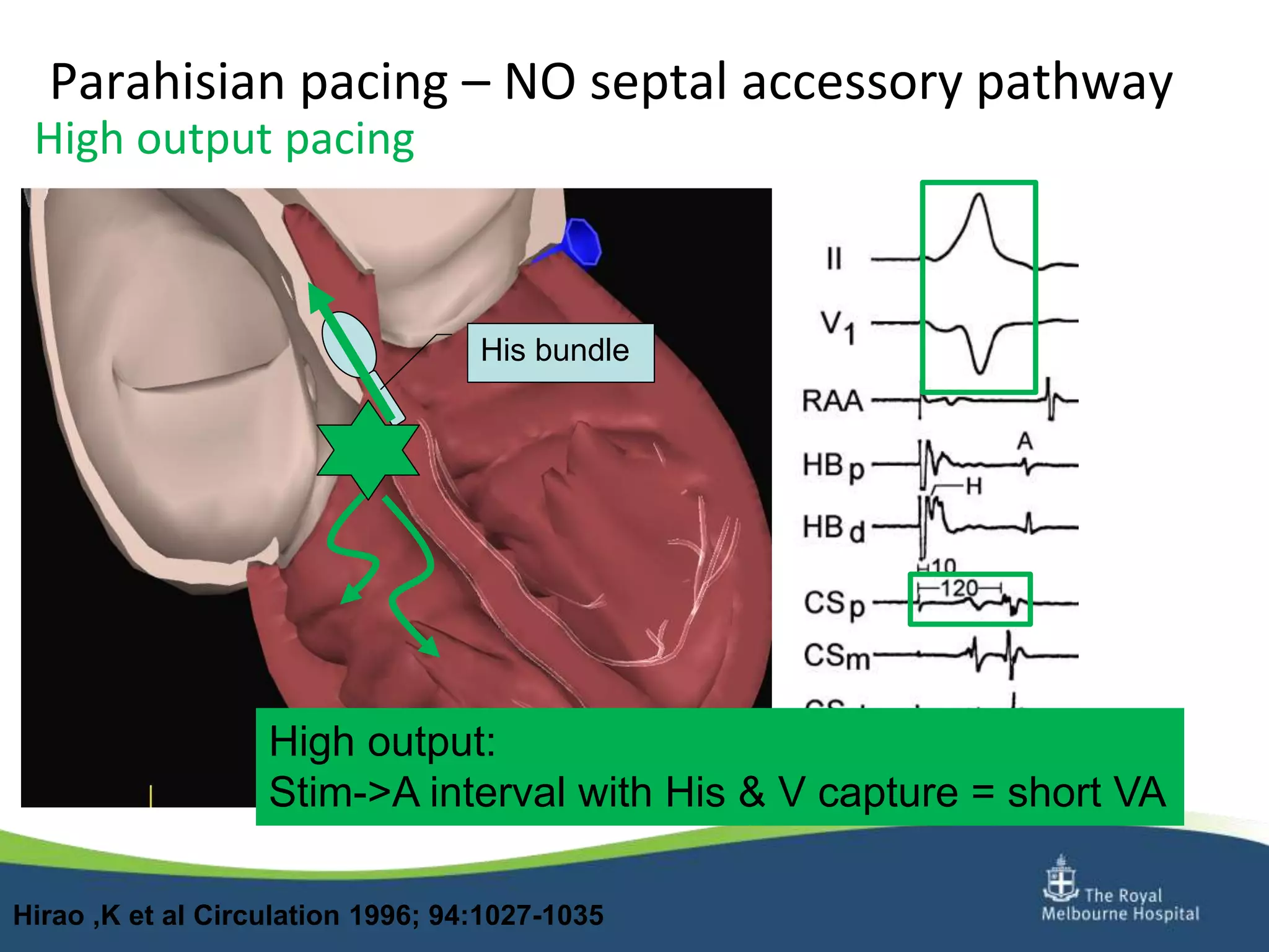 How to perform an ep study and diagnostic pacing during sinus rhythm | PPTX