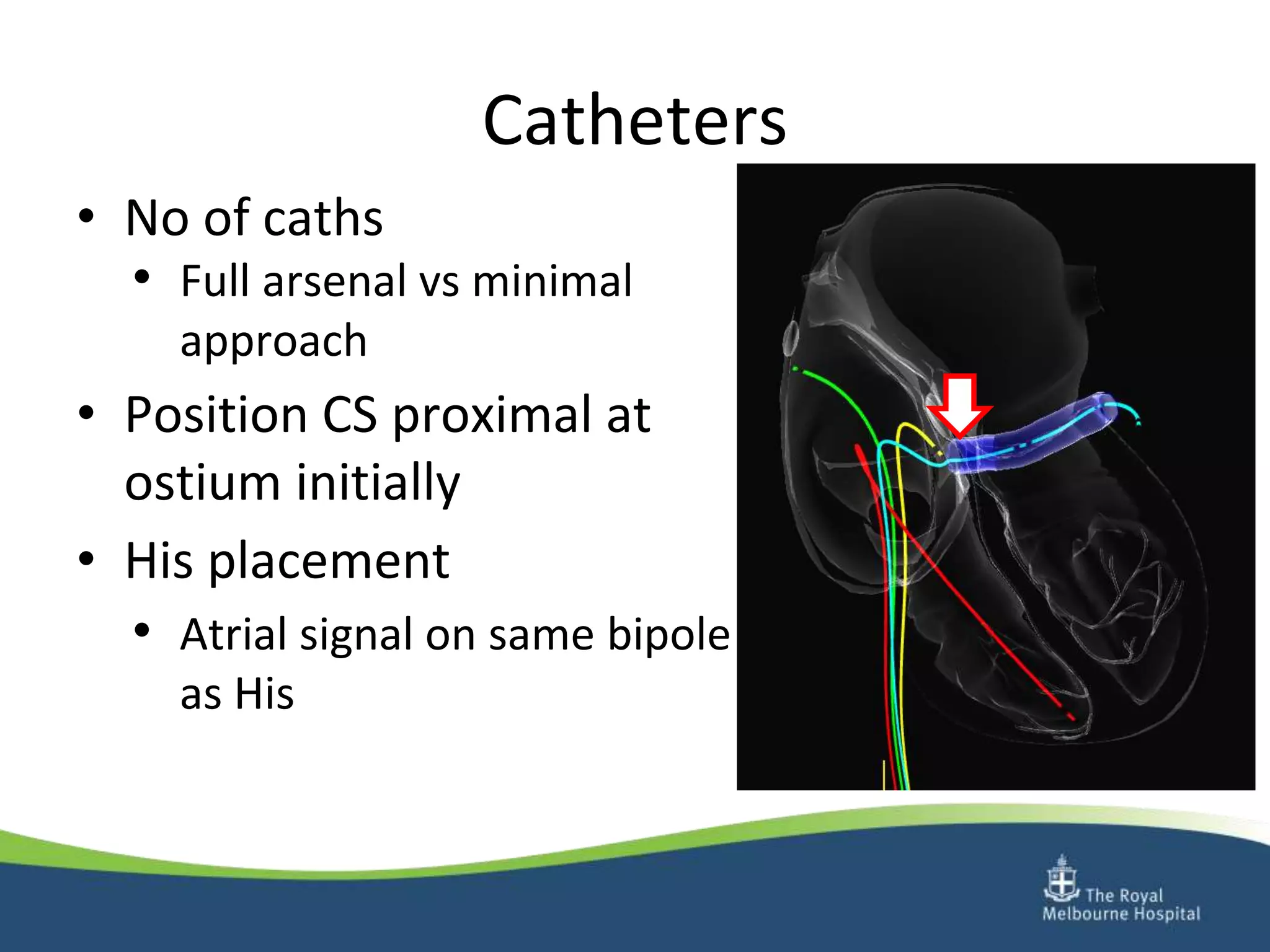 How to perform an ep study and diagnostic pacing during sinus rhythm | PPTX
