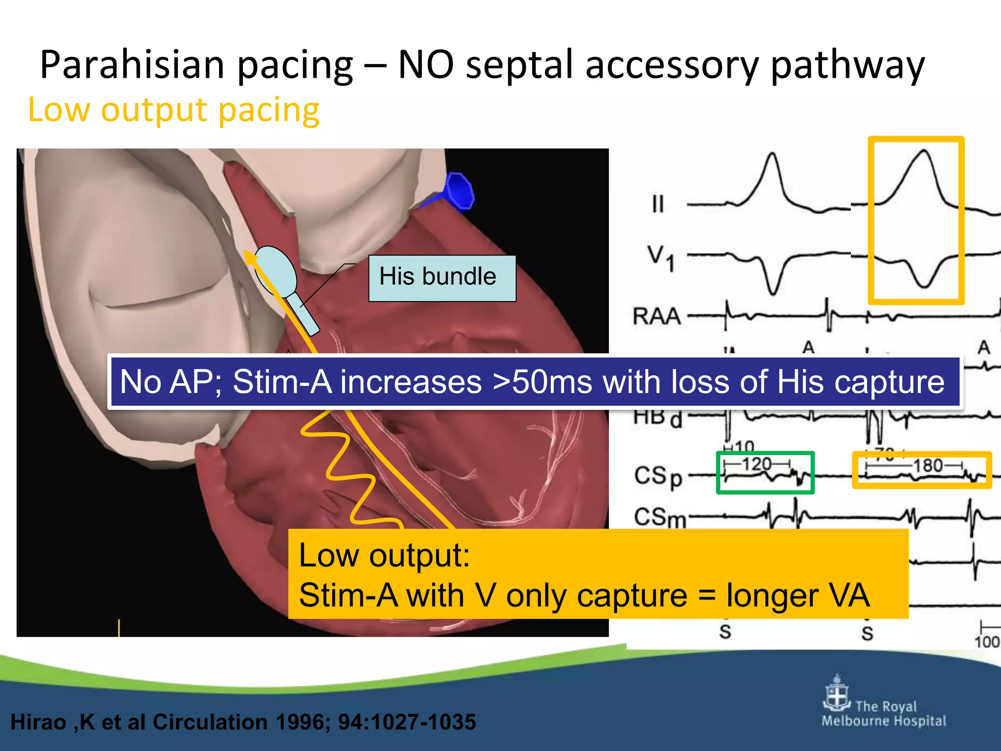 How to perform an ep study and diagnostic pacing during sinus rhythm | PPTX