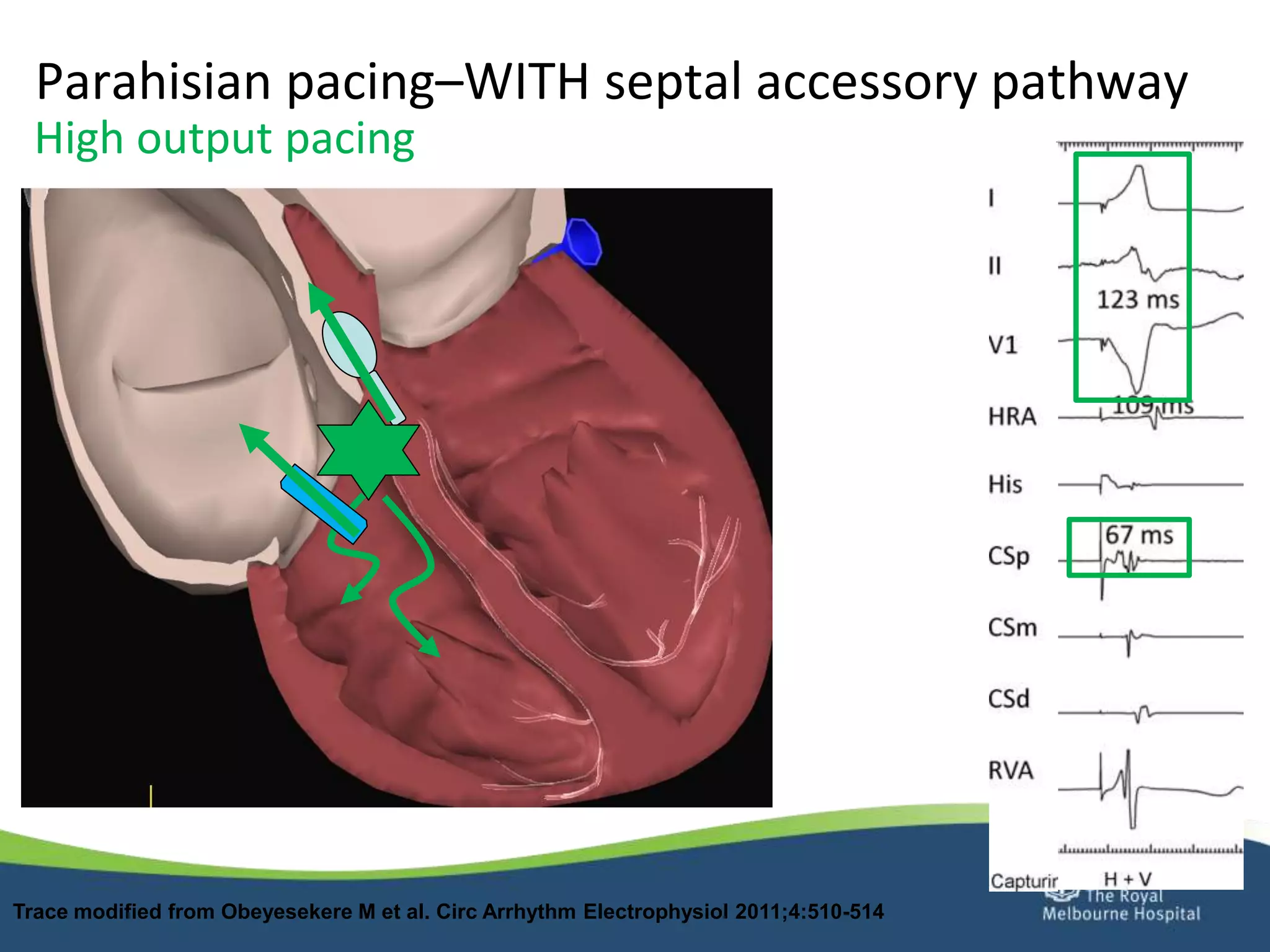 How to perform an ep study and diagnostic pacing during sinus rhythm | PPTX