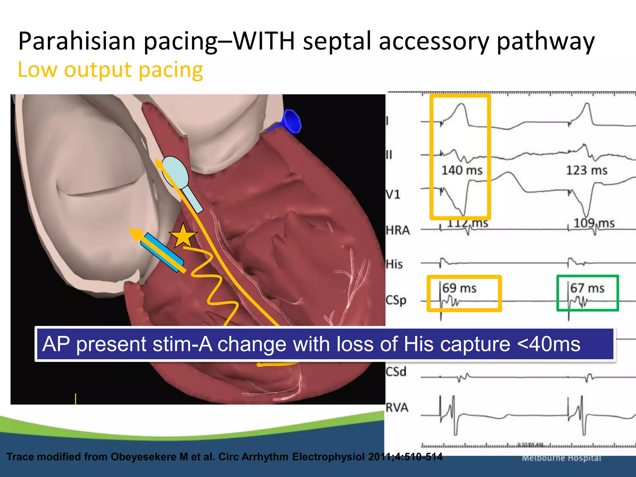 How to perform an ep study and diagnostic pacing during sinus rhythm | PPTX