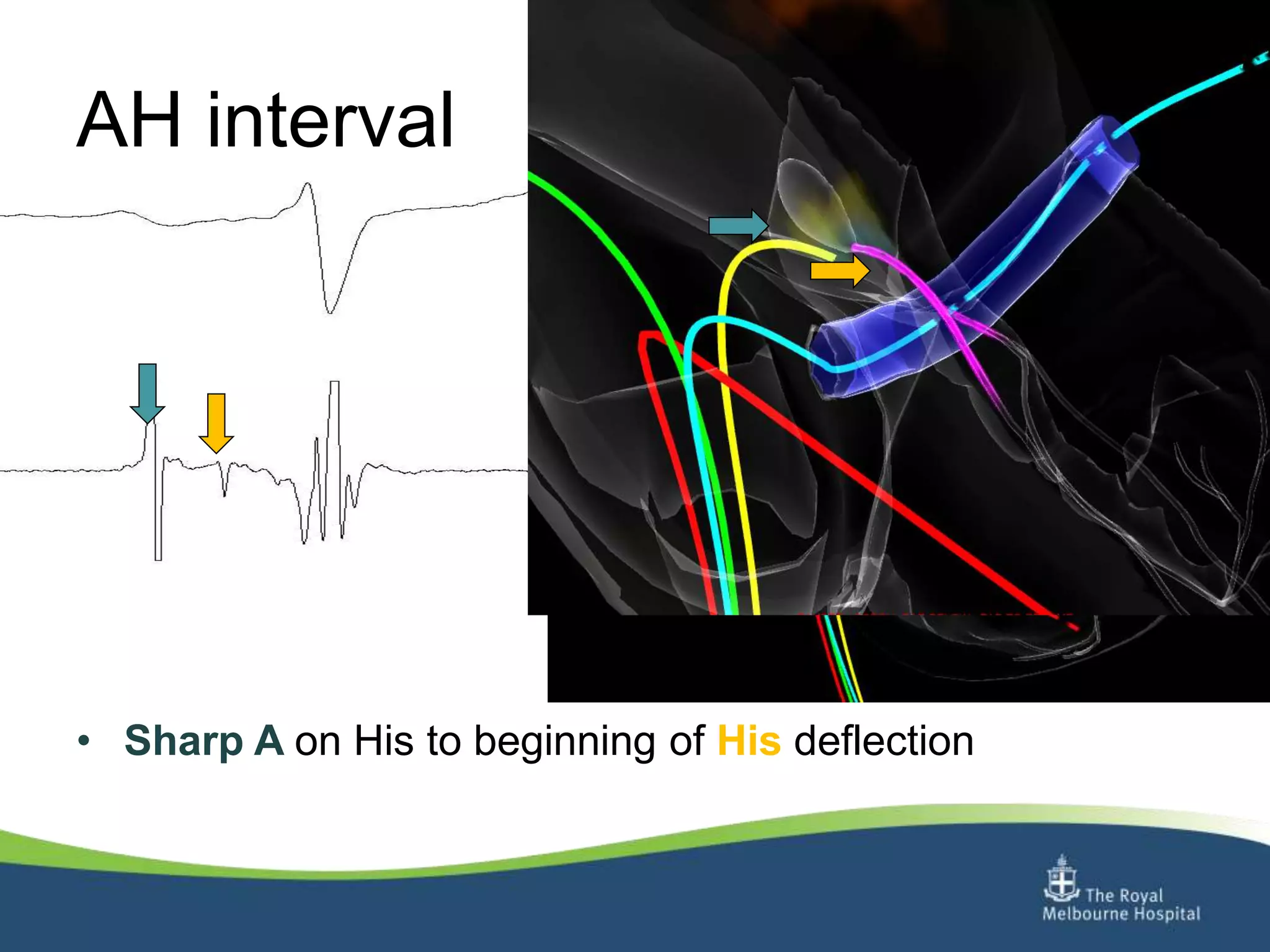 How to perform an ep study and diagnostic pacing during sinus rhythm | PPTX