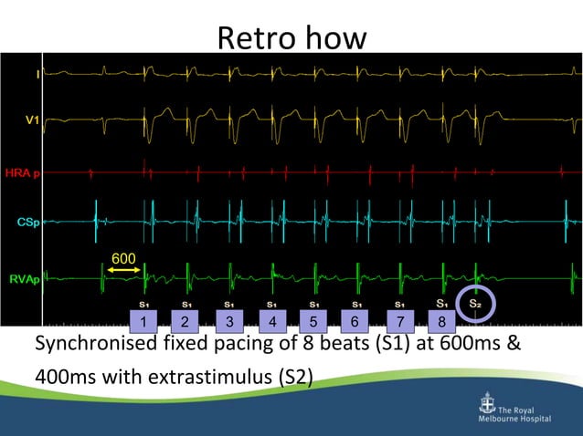 How to perform an ep study and diagnostic pacing during sinus rhythm | PPTX