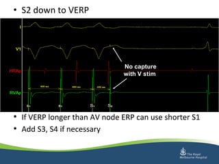 How to perform an ep study and diagnostic pacing during sinus rhythm | PPTX