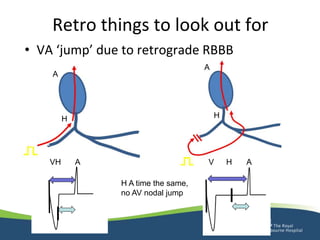 How to perform an ep study and diagnostic pacing during sinus rhythm | PPTX