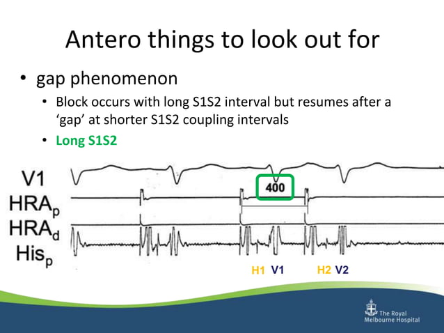 How to perform an ep study and diagnostic pacing during sinus rhythm | PPTX