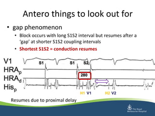 How to perform an ep study and diagnostic pacing during sinus rhythm | PPTX