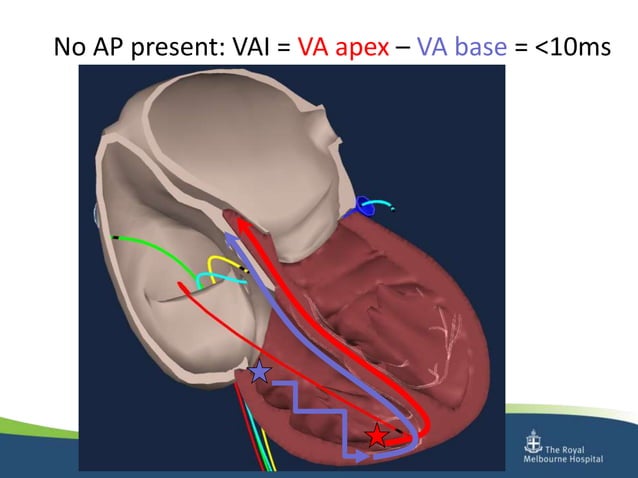 How to perform an ep study and diagnostic pacing during sinus rhythm | PPTX