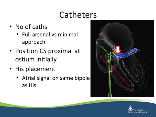 How to perform an ep study and diagnostic pacing during sinus rhythm | PPTX