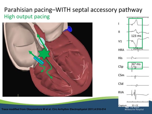 How to perform an ep study and diagnostic pacing during sinus rhythm | PPTX