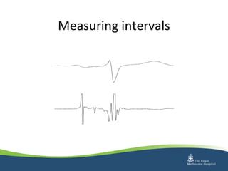 How to perform an ep study and diagnostic pacing during sinus rhythm | PPTX