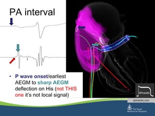 How to perform an ep study and diagnostic pacing during sinus rhythm | PPTX