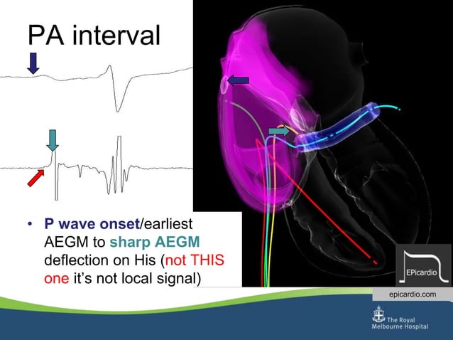 How to perform an ep study and diagnostic pacing during sinus rhythm | PPTX