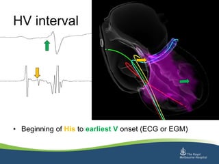 How to perform an ep study and diagnostic pacing during sinus rhythm | PPTX