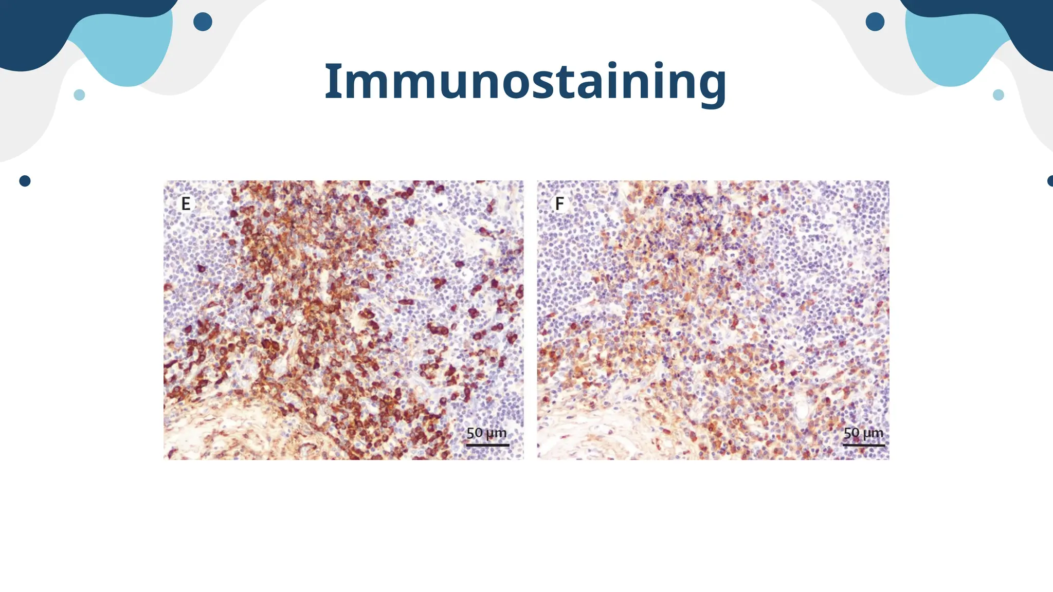 IgG4 related disorders(diagnosis and management).pptx