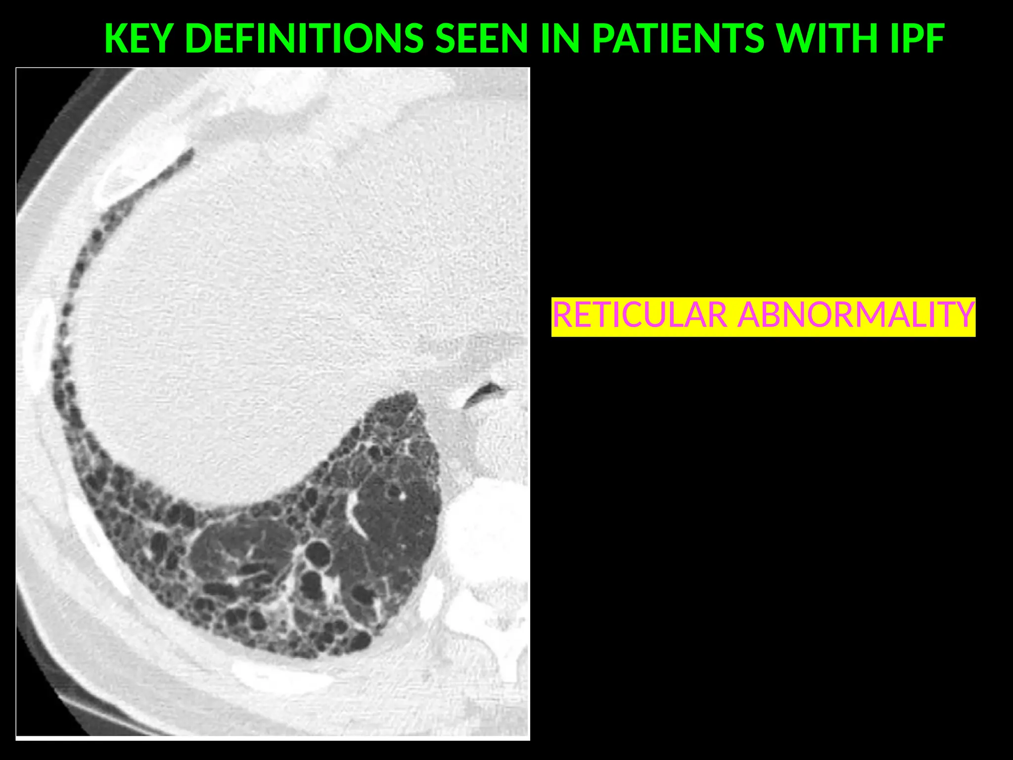 HRCT SCAN IN INTERSTITIAL LUNG DISEASE .pptx