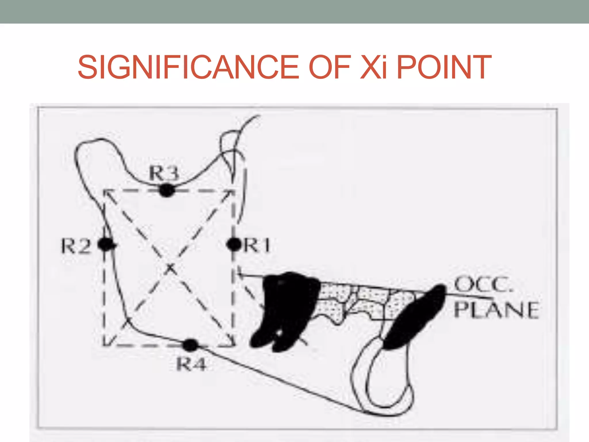 Impacted third molars | PPTX