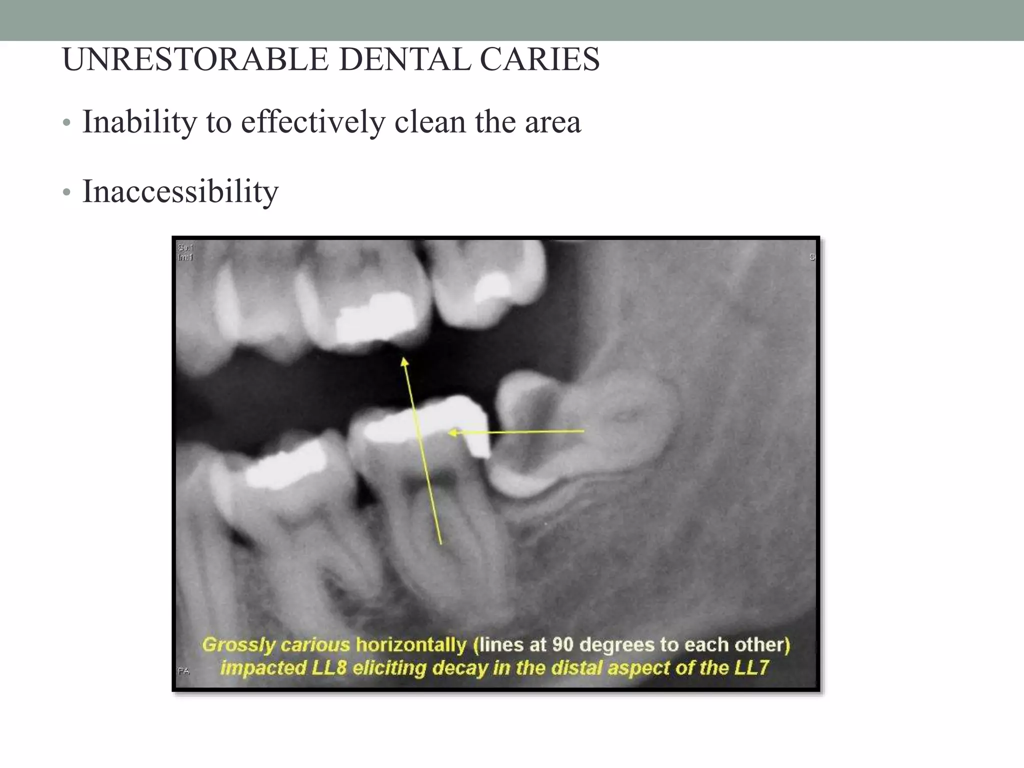 Impacted third molars | PPTX