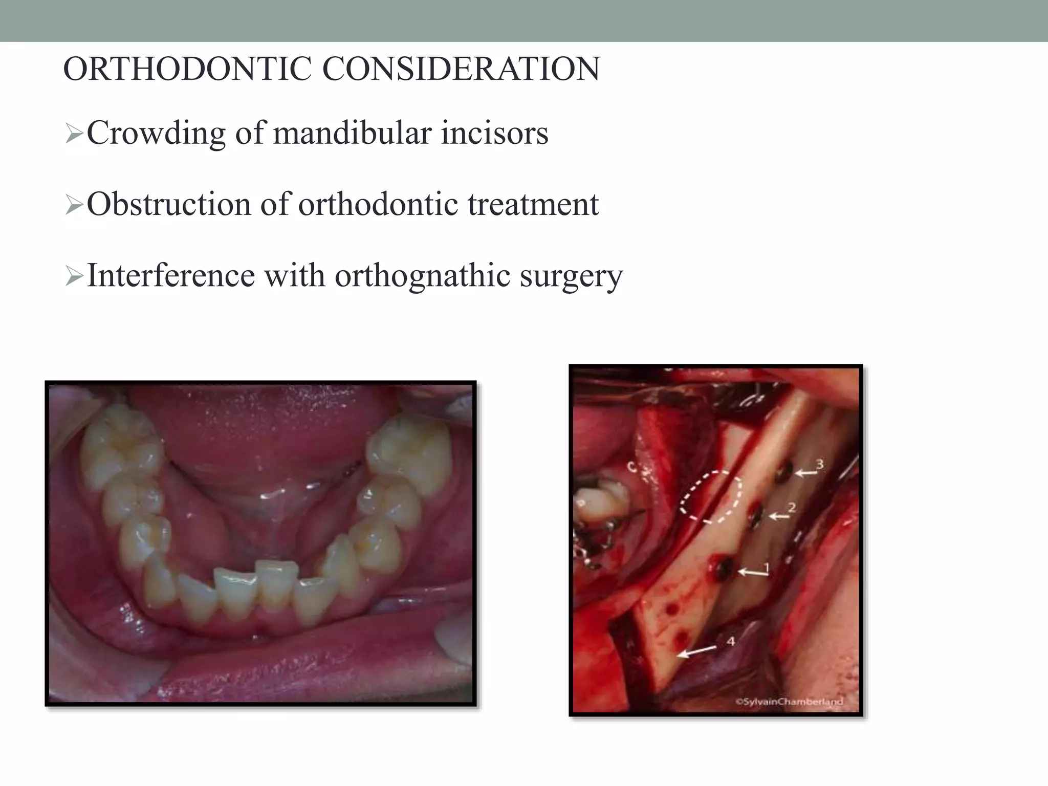 Impacted third molars | PPTX