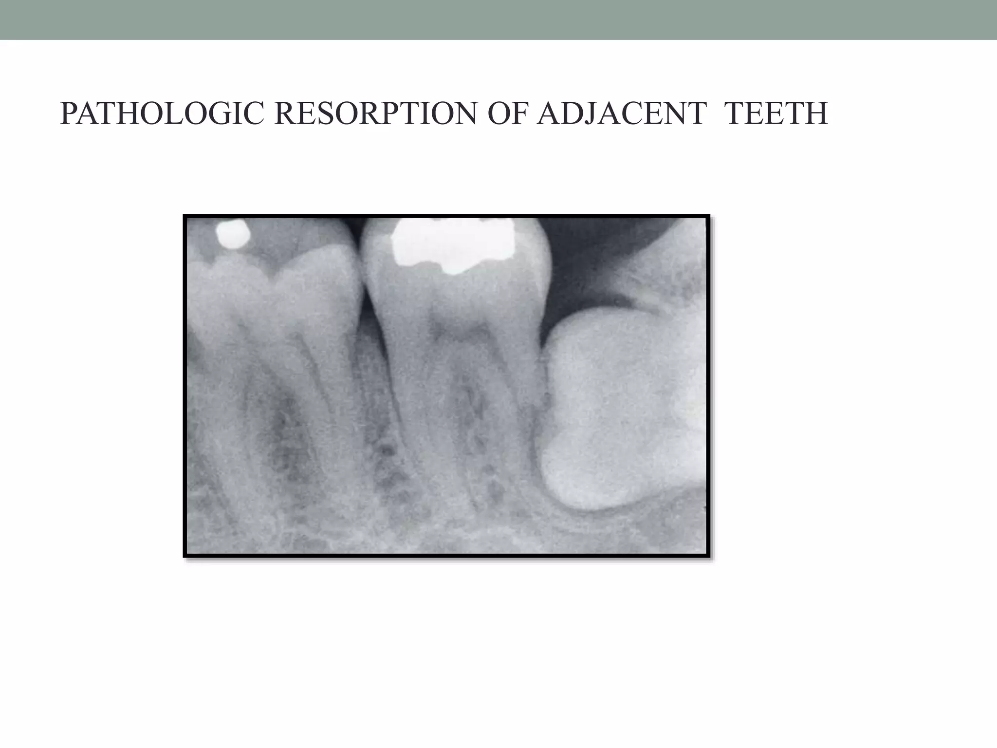 Impacted third molars | PPTX