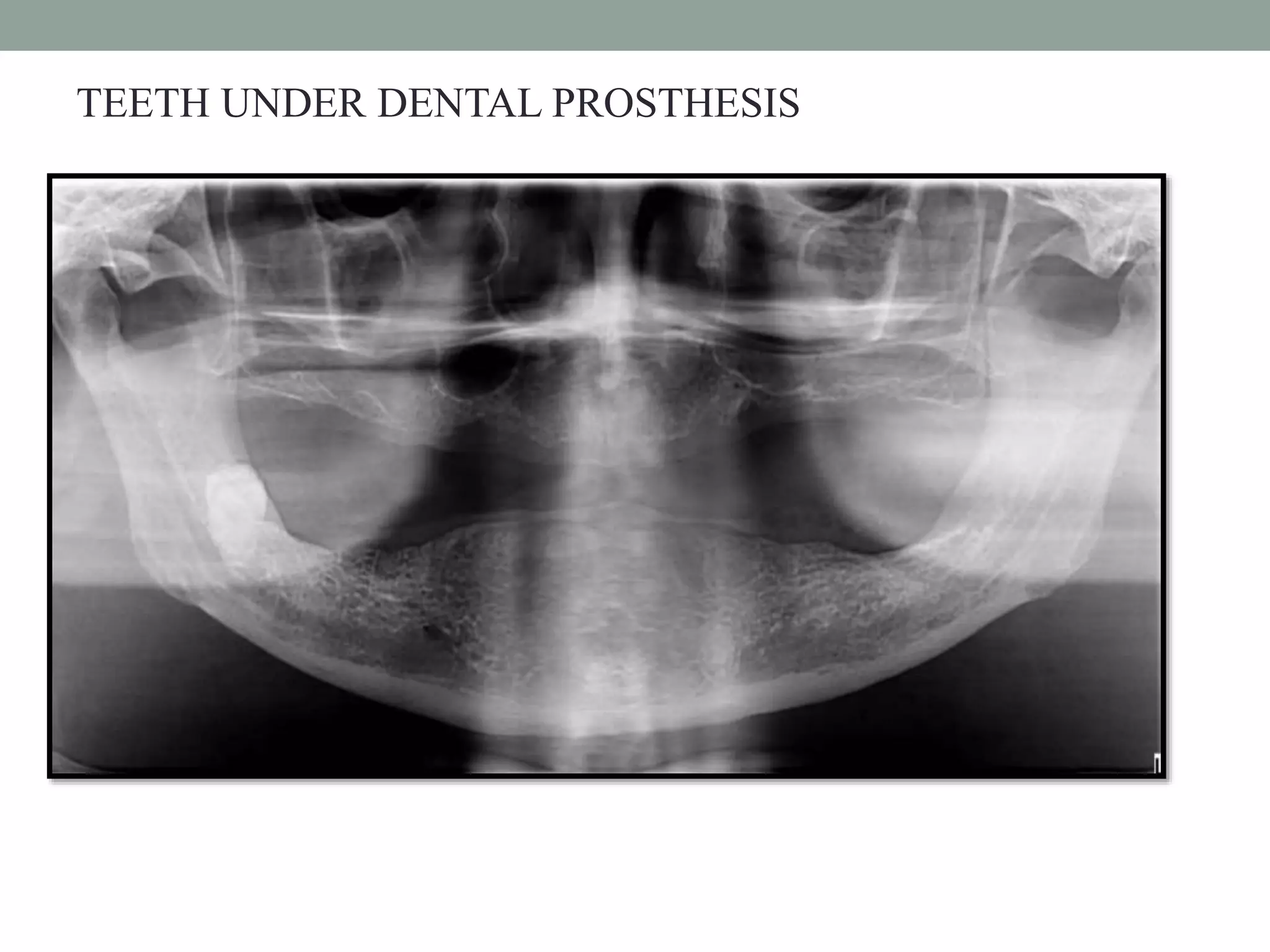 Impacted third molars | PPTX