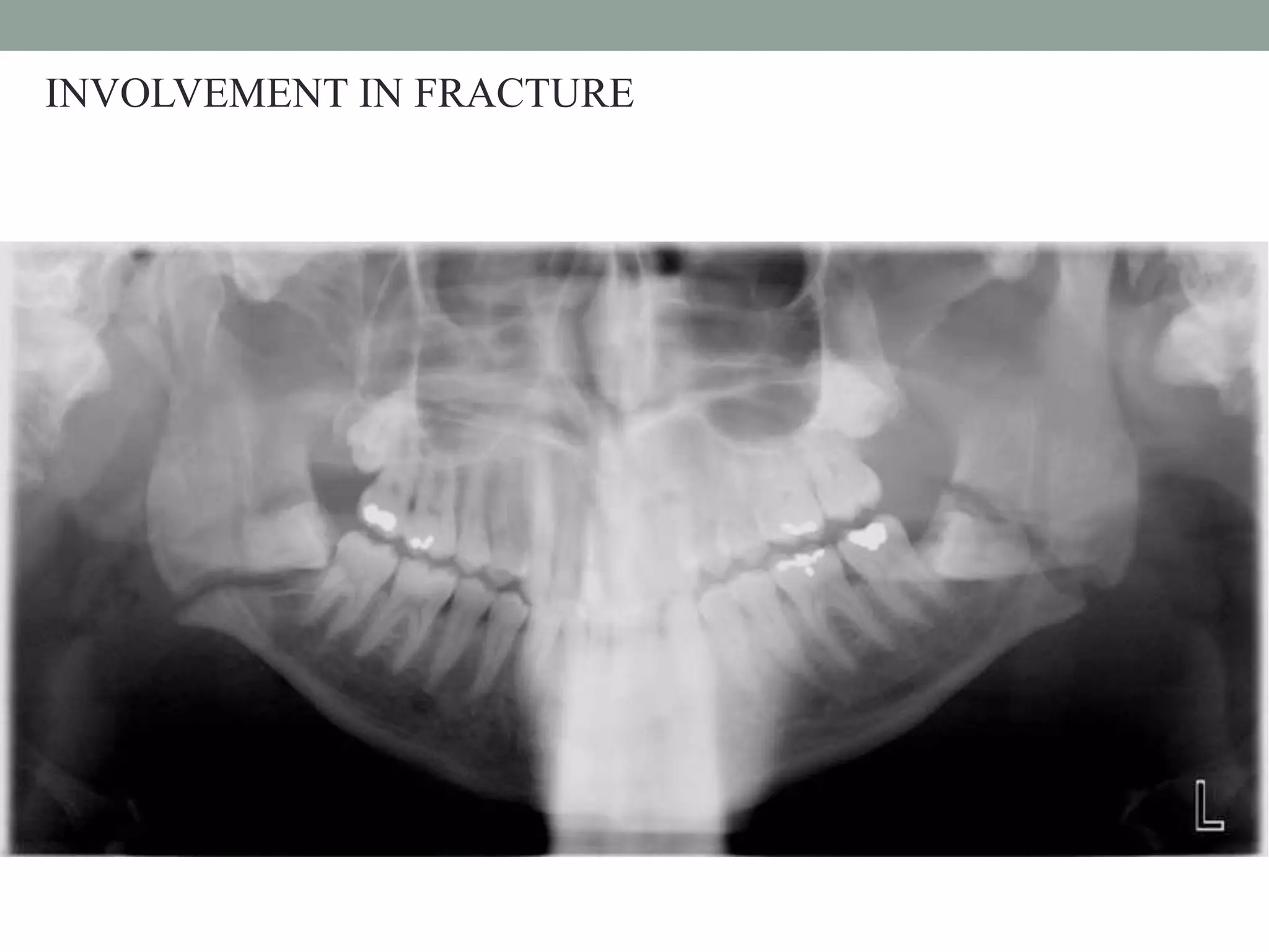 Impacted third molars | PPTX