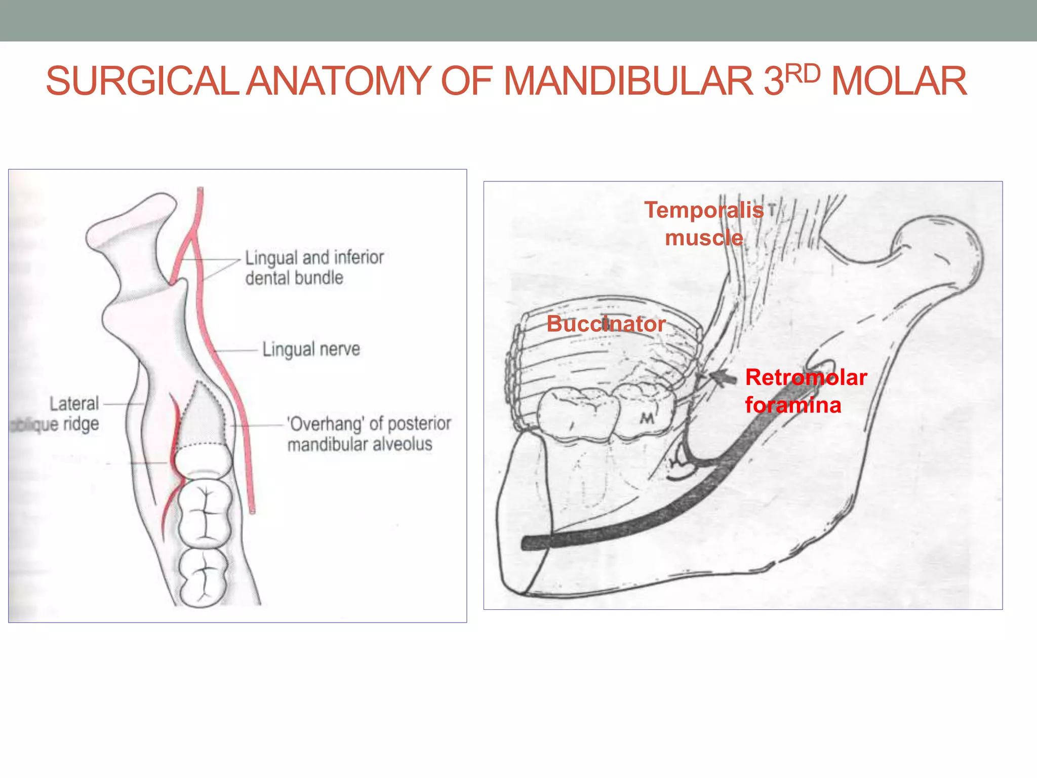 Impacted third molars | PPTX
