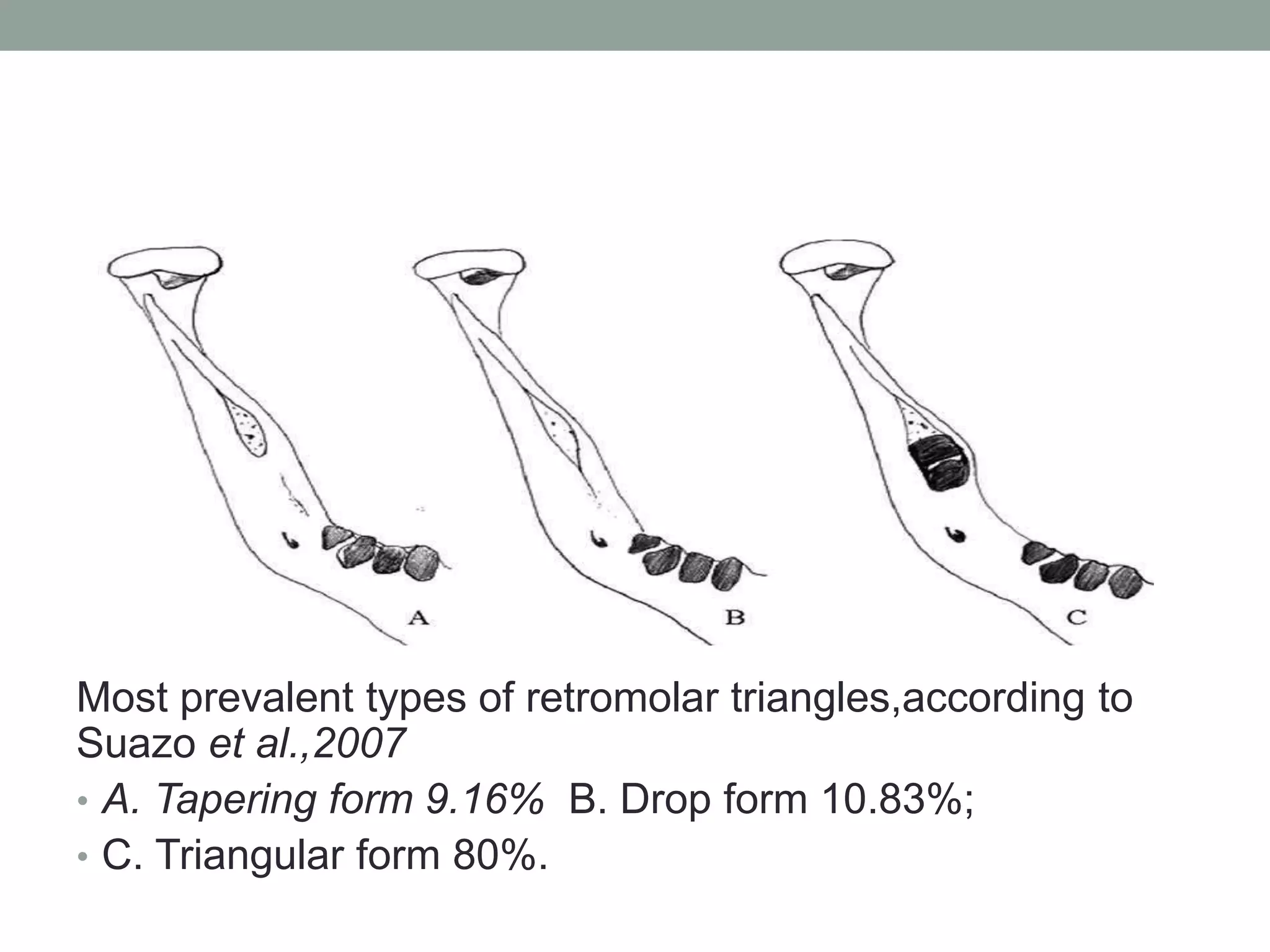 Impacted third molars | PPTX