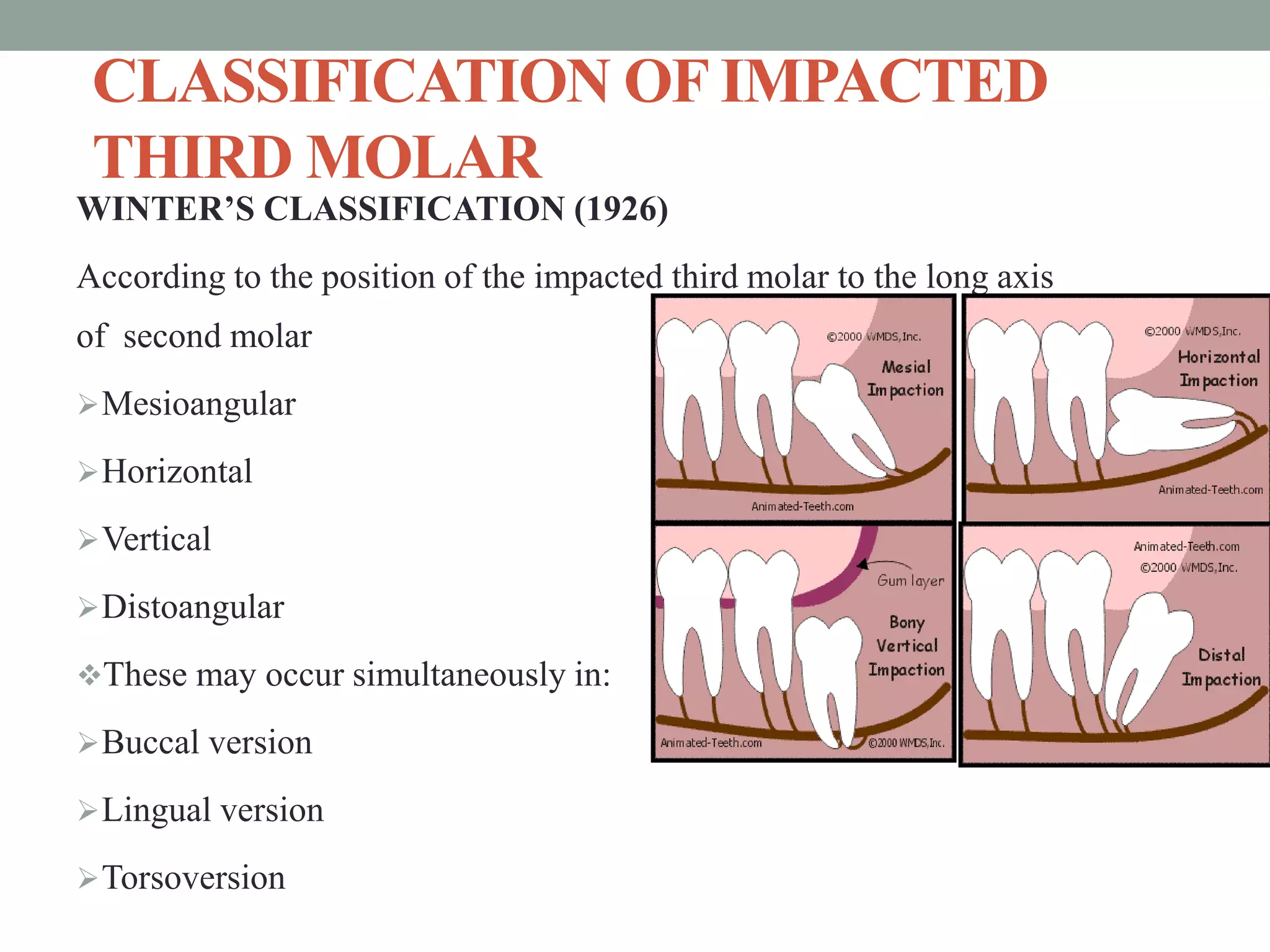 Impacted third molars | PPTX