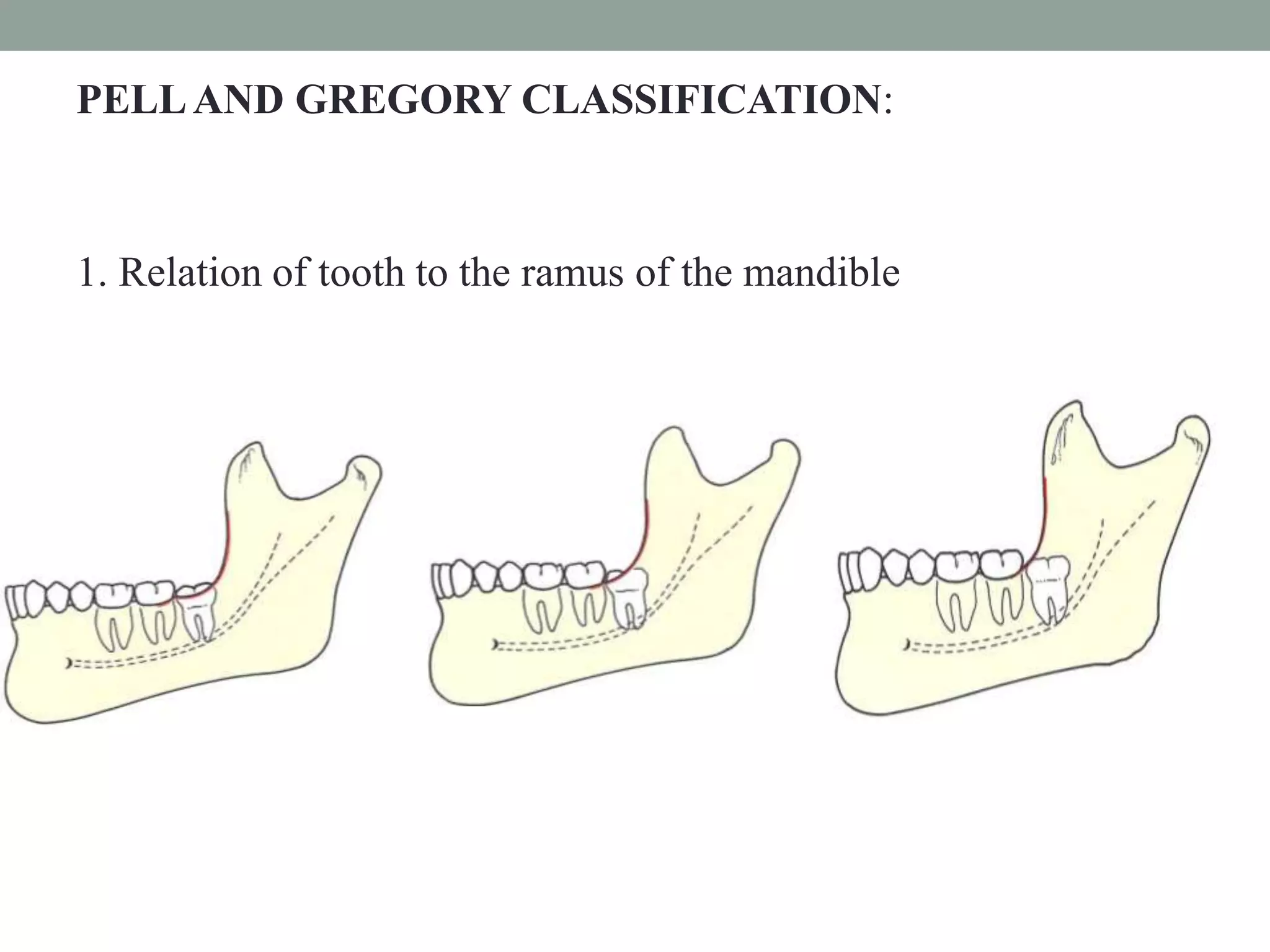 Impacted third molars | PPTX