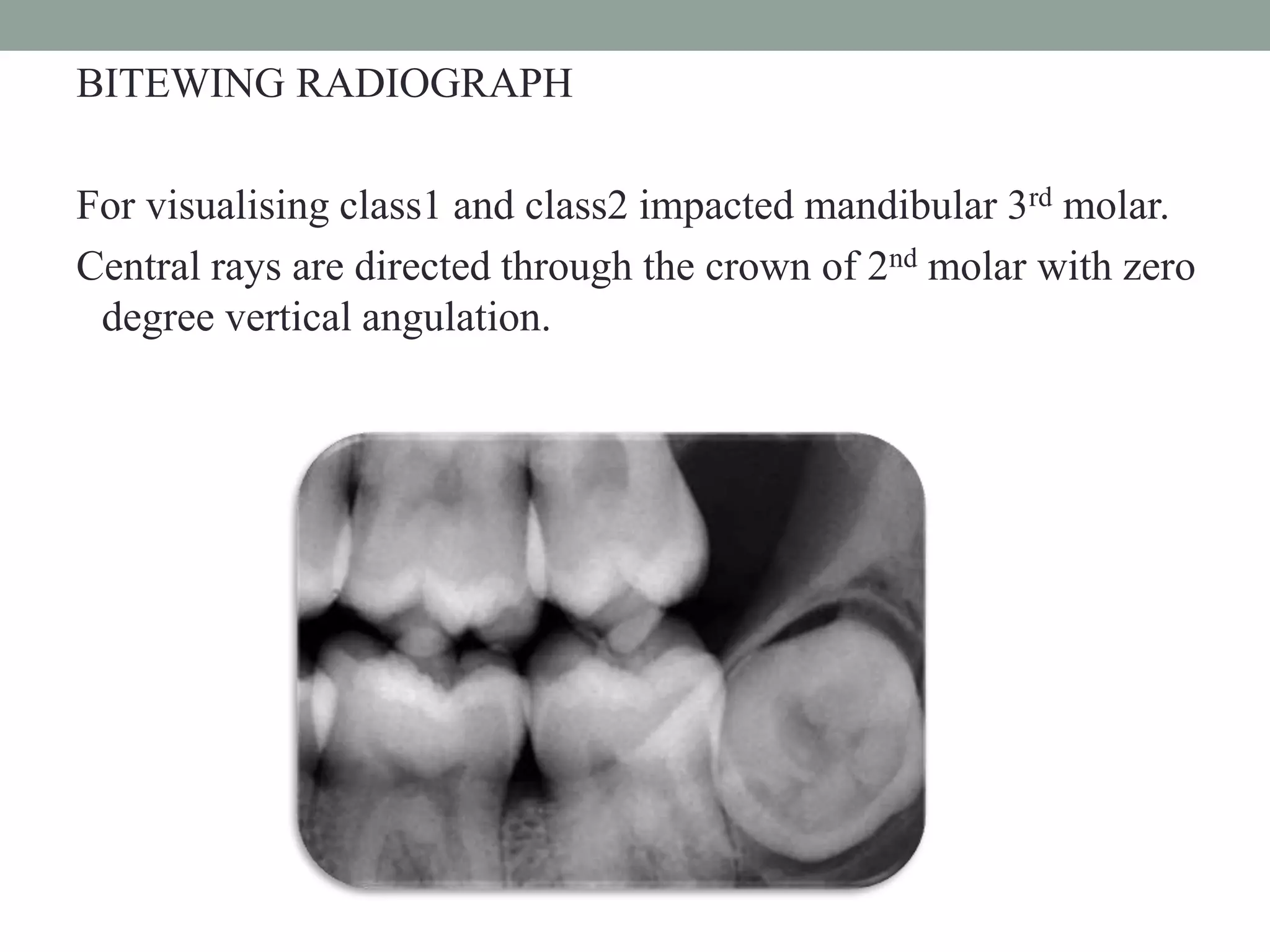 Impacted third molars | PPTX