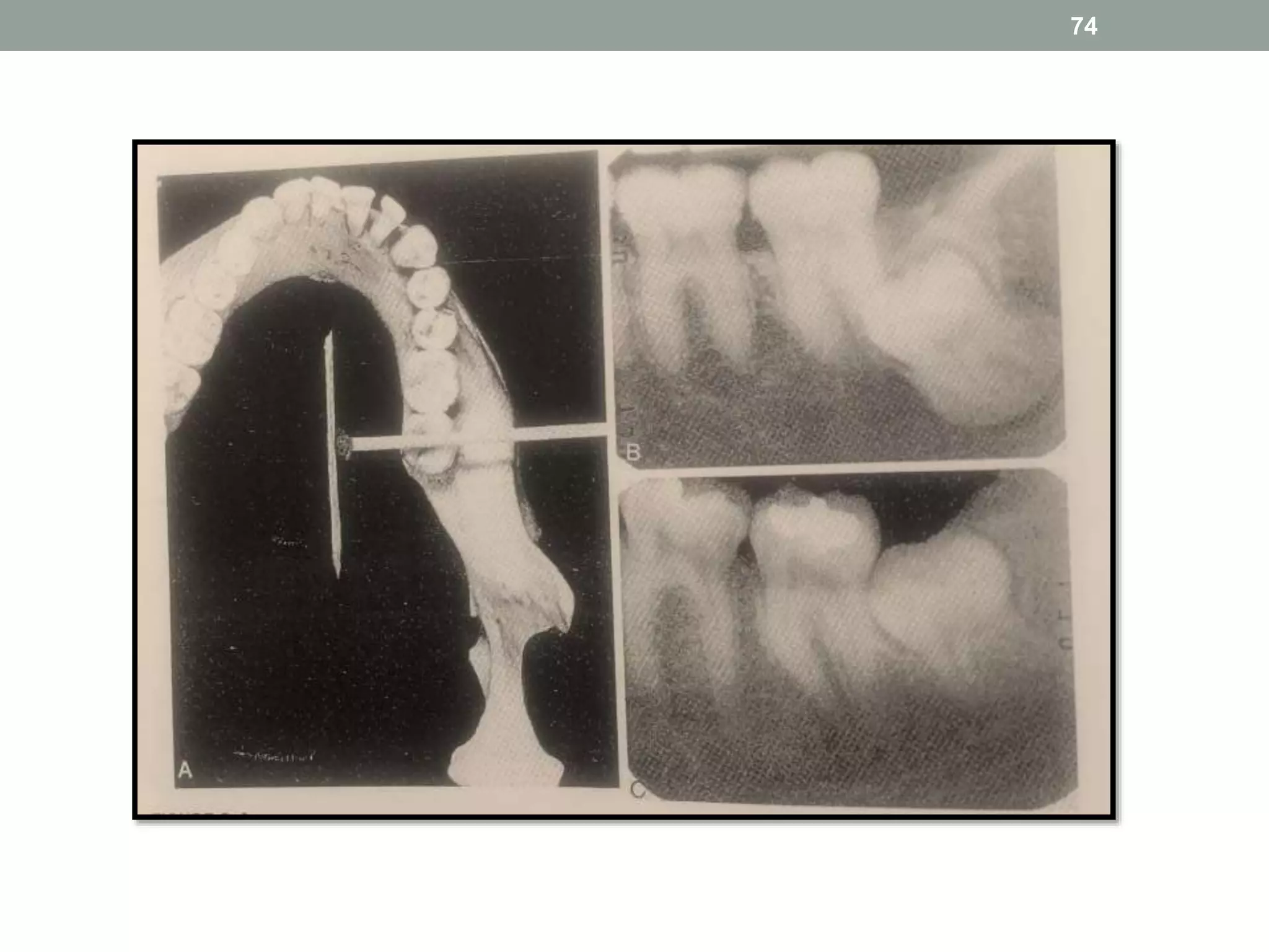Impacted third molars | PPTX