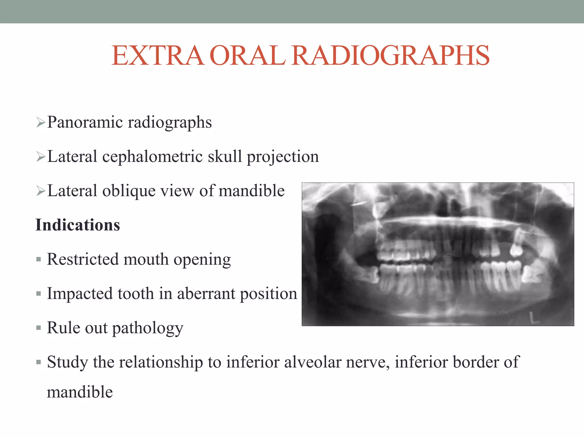Impacted third molars | PPTX