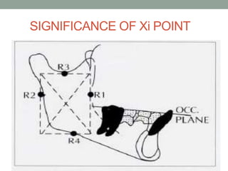Impacted third molars | PPTX