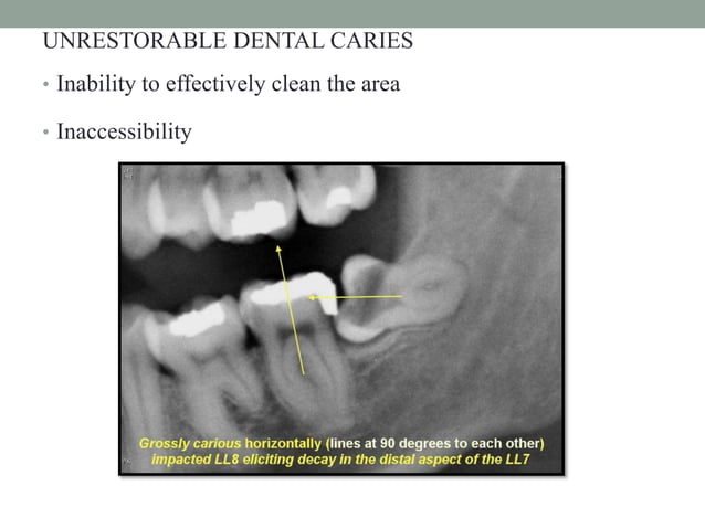 Impacted third molars | PPTX | Dental Health | Diseases and Conditions