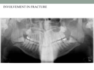 Impacted third molars | PPTX
